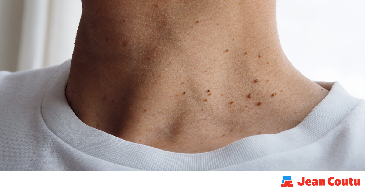 How to get rid of acrochordons | Jean Coutu