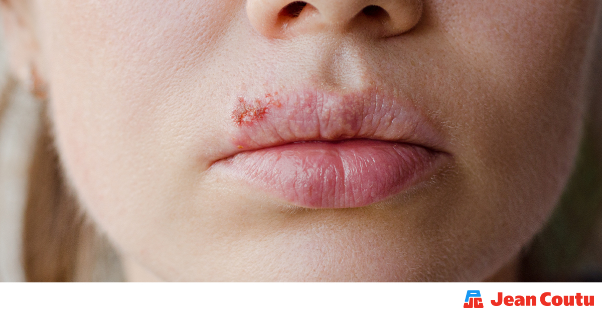 Herpès labial : prévention et options de traitement | Jean Coutu
